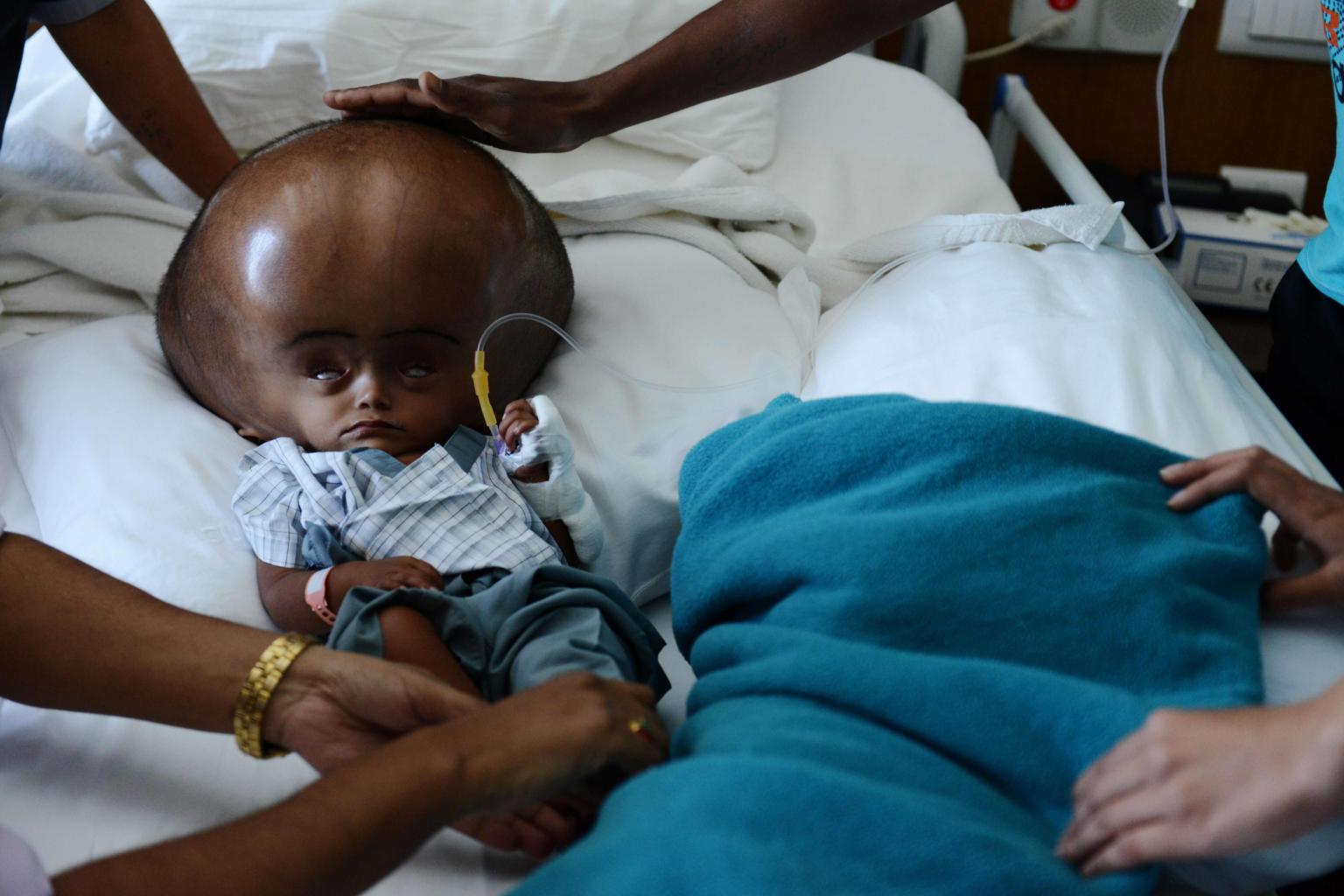 Indian girl Roona Begum with rare swollen head condition dies suddenly ...
