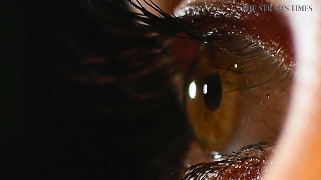 Woman infected with eye worm known only in cattle | The Straits Times