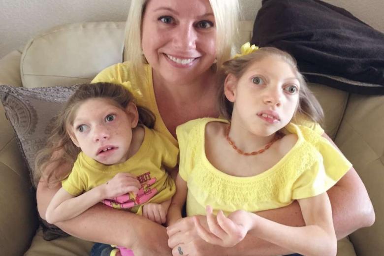 Living with microcephaly: A story of two sisters, The Hartley Hooligans ...
