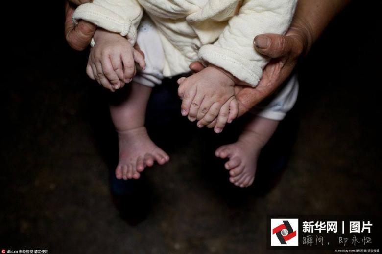 Parents of China baby boy born with 31 fingers and toes seek help for ...