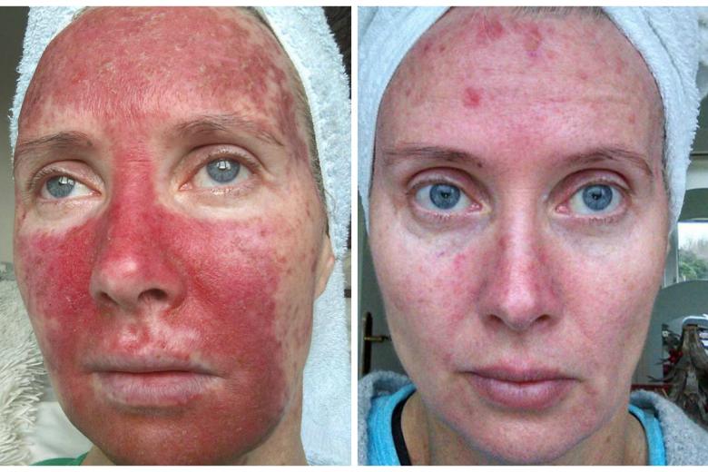 Woman's warnings about sunbathing go viral | The Straits Times