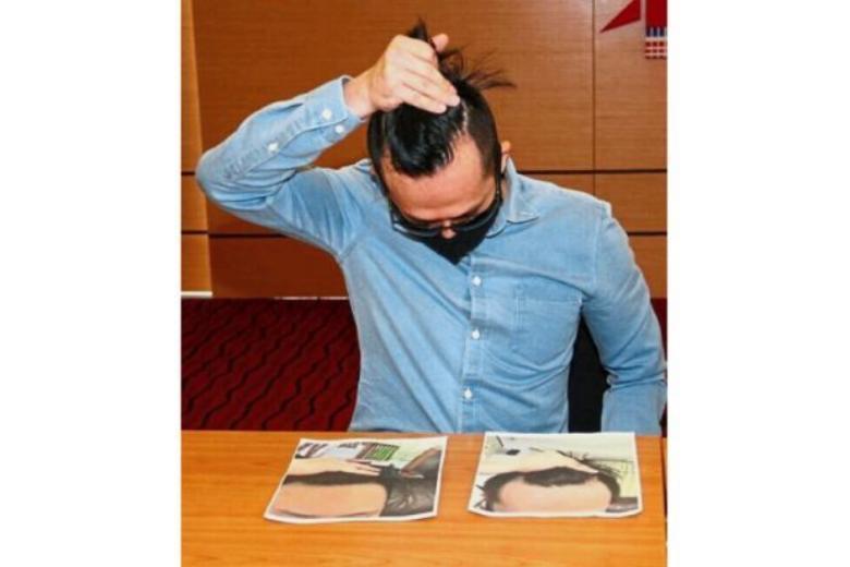 Ipoh salesman goes for hair replacement treatment in Taiwan but returns ...