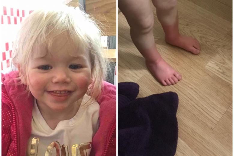 18-month-old toddler in US has rare allergy to water | The Straits Times