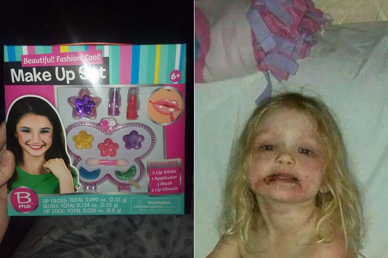 US girl, 3, suffers blisters on her face in severe allergic reaction to ...