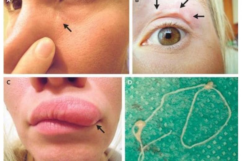 Blemishes moving around on Russian woman's face turned out to be ...