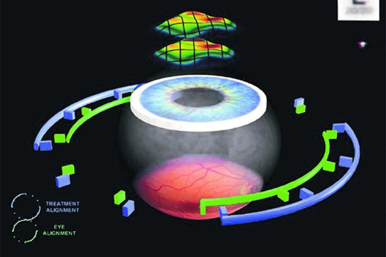 Am I too old for LASIK eye surgery? | The Straits Times