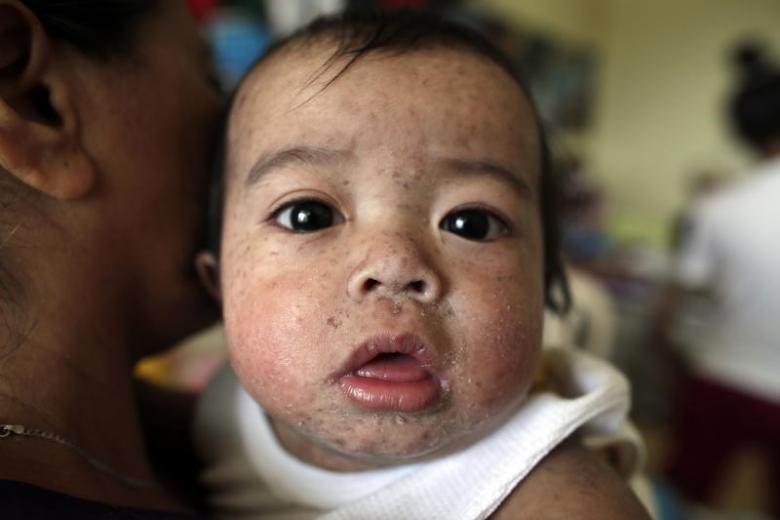 Philippines hit by deadly measles outbreak after controversy over ...