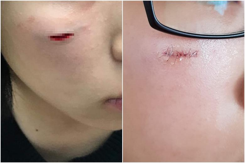 Teenager receives 9 stitches on face after suffering cut at Jewel's ...