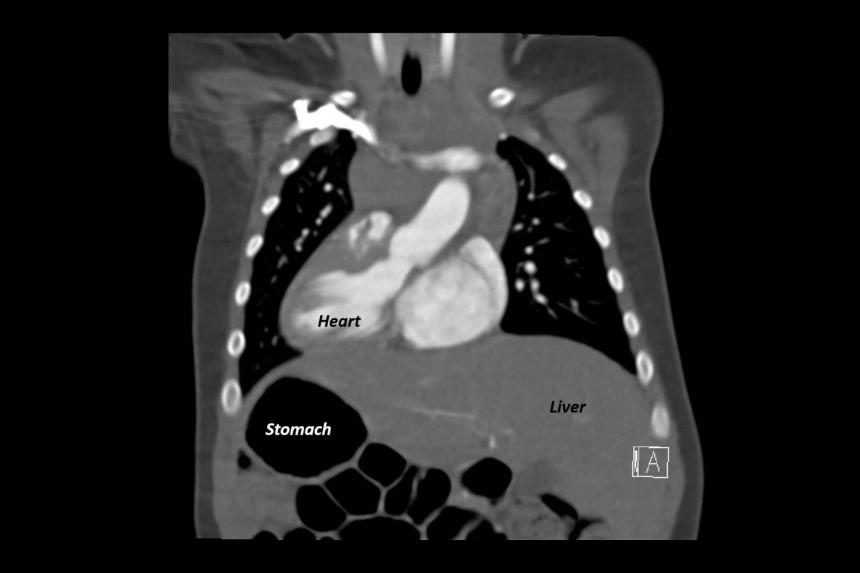 Should I be worried if the positions of my baby’s organs are reversed ...