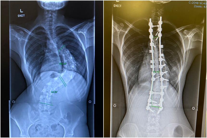 Blame the brain for spine curvature, researchers say | The Straits Times