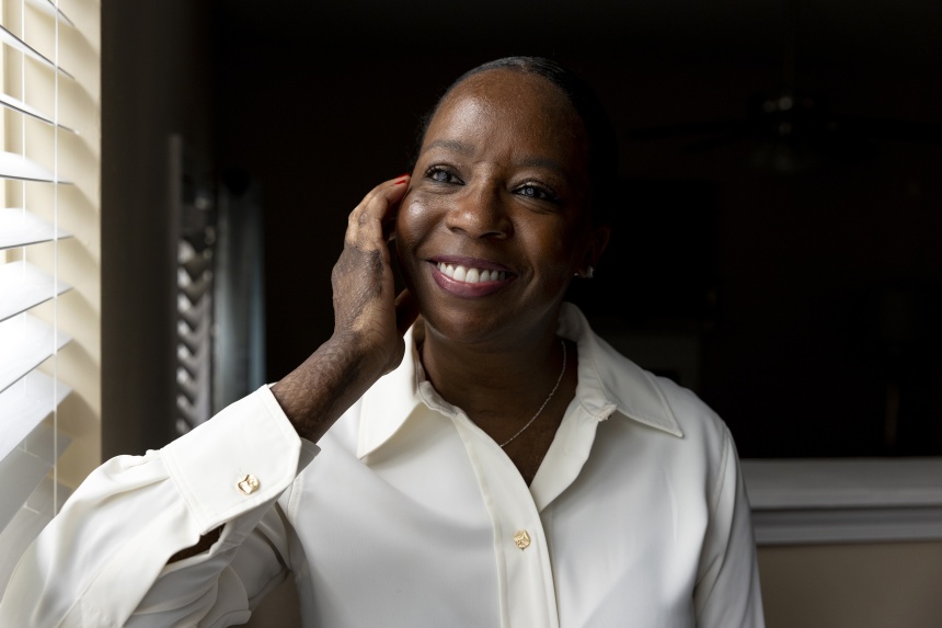 Human placenta makes woman’s face ‘look exactly like before’ after ...