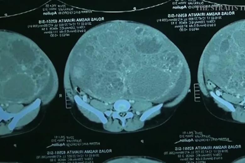 Giant tumor removed from Peruvian woman | The Straits Times